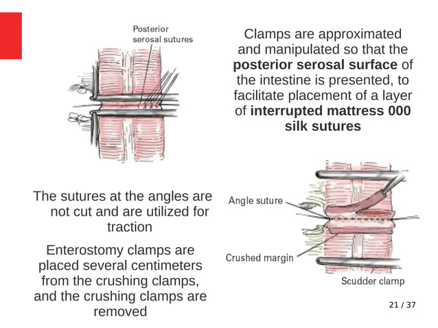 Lt Hemicolectomy Surgical Approach Complications Ppt