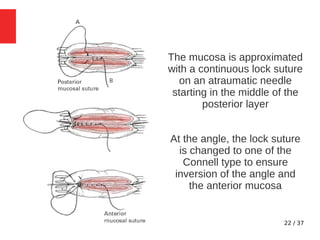 Lt hemicolectomy - Surgical Approach, Complications. | PDF