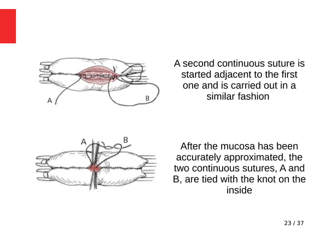 Lt Hemicolectomy Surgical Approach Complications Ppt