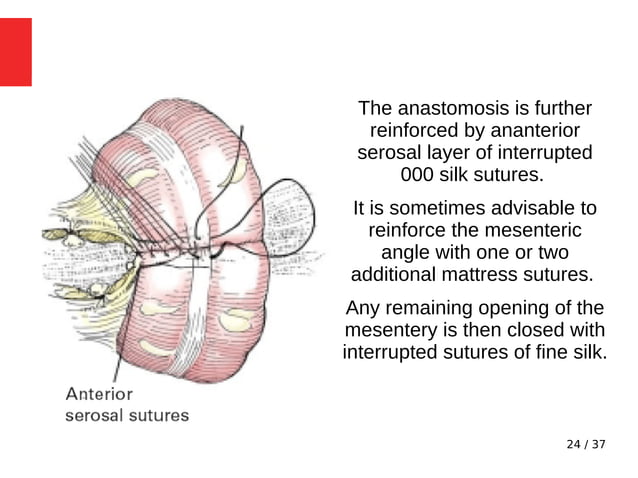 Lt hemicolectomy - Surgical Approach, Complications. | PDF