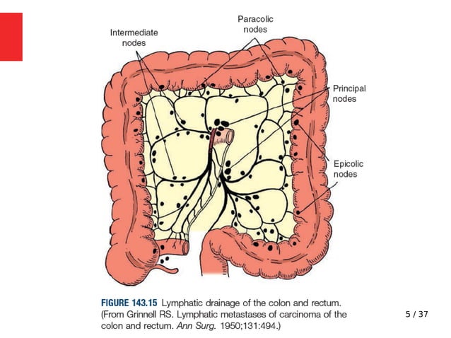 Lt hemicolectomy - Surgical Approach, Complications. | PDF