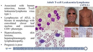 LU9 Haematology Lymphoproliferative disorders.pptx