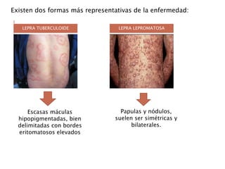Lucha contra la lepra | PPTX