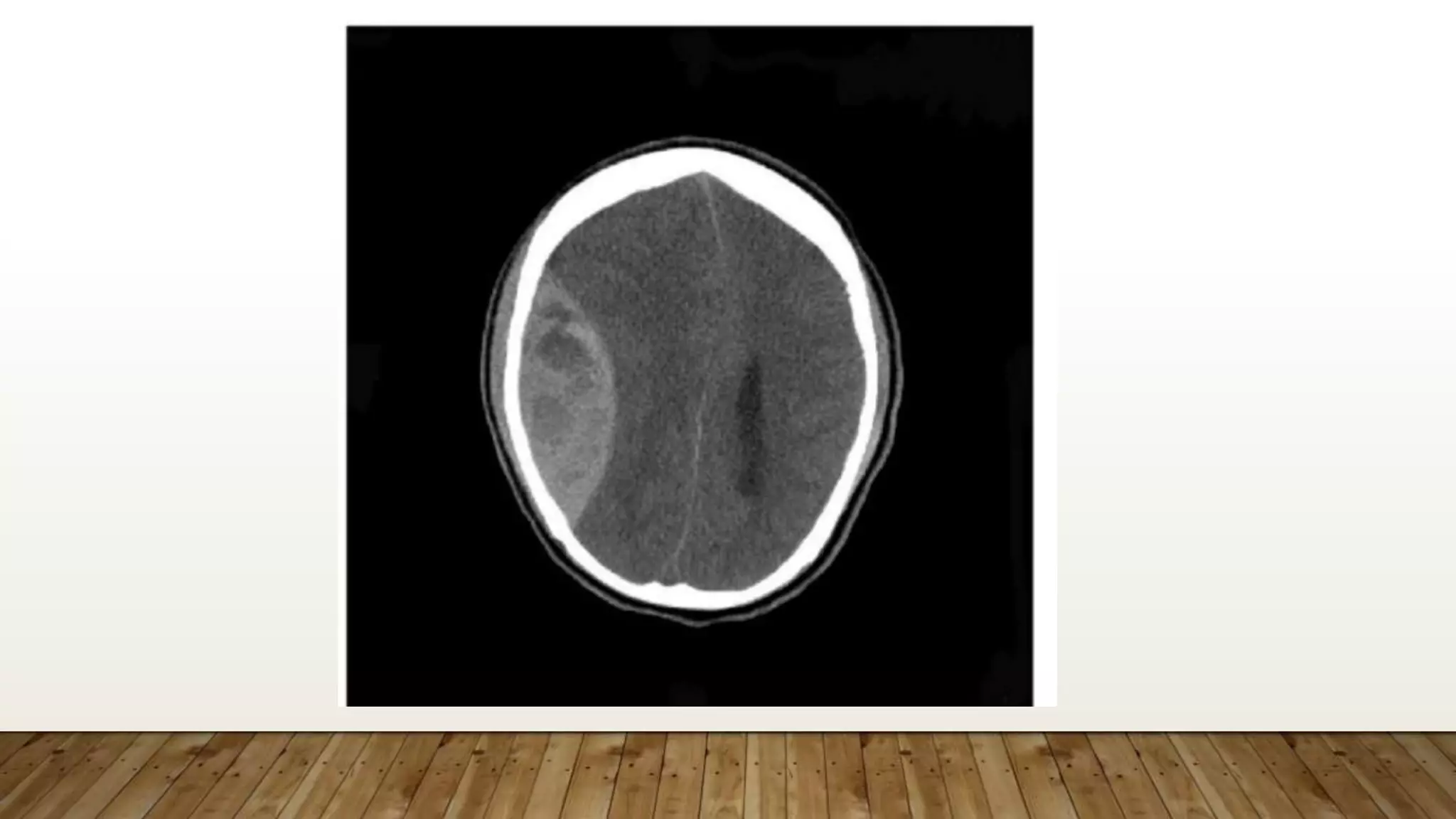 lucid interval and its importance in trauma and mental health | PPTX