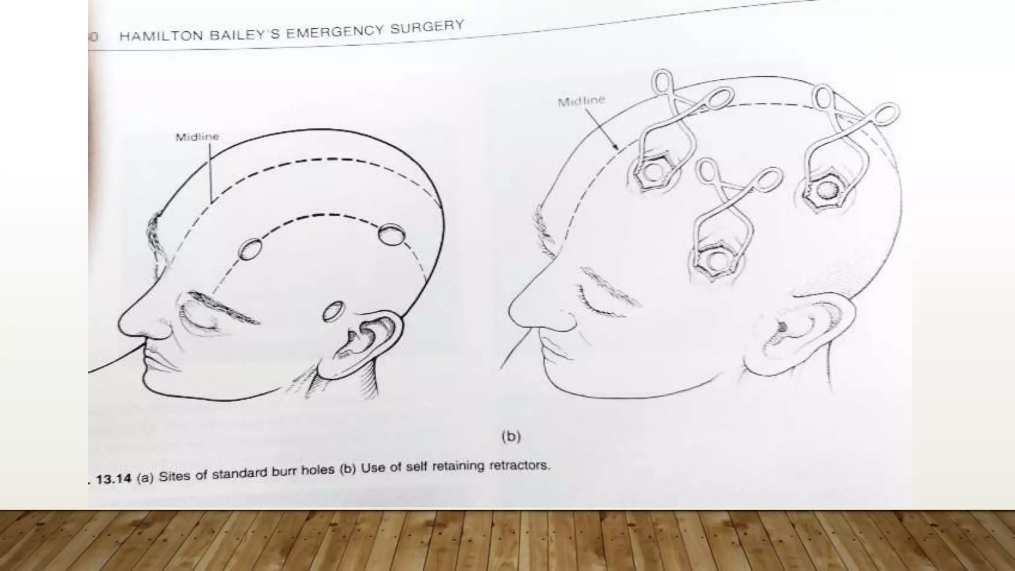 lucid interval and its importance in trauma and mental health | PPTX