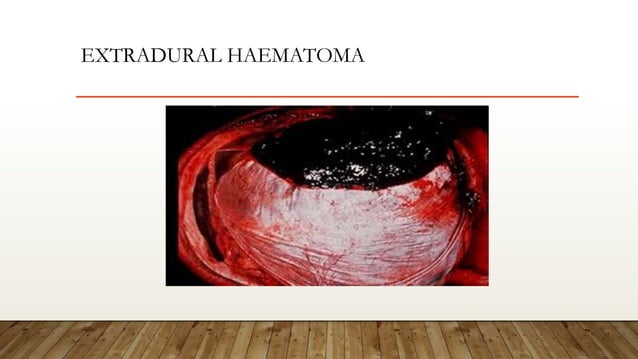lucid interval and its importance in trauma and mental health | PPTX ...