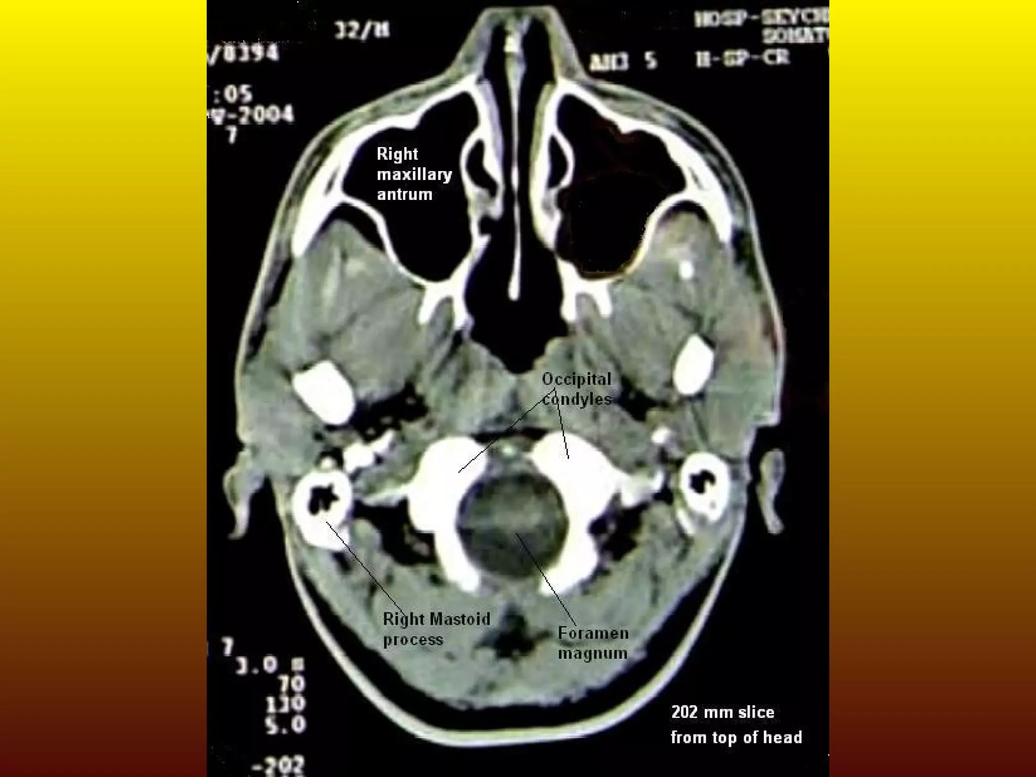 "Lucky" Bullet in Infratemporal Fossa | PPT | Injuries | Diseases and ...