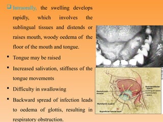 LUDWIG ANGINA LUDWIG ANGINA LUDWIG ANGINA LUDWIG ANGINA | PPTX
