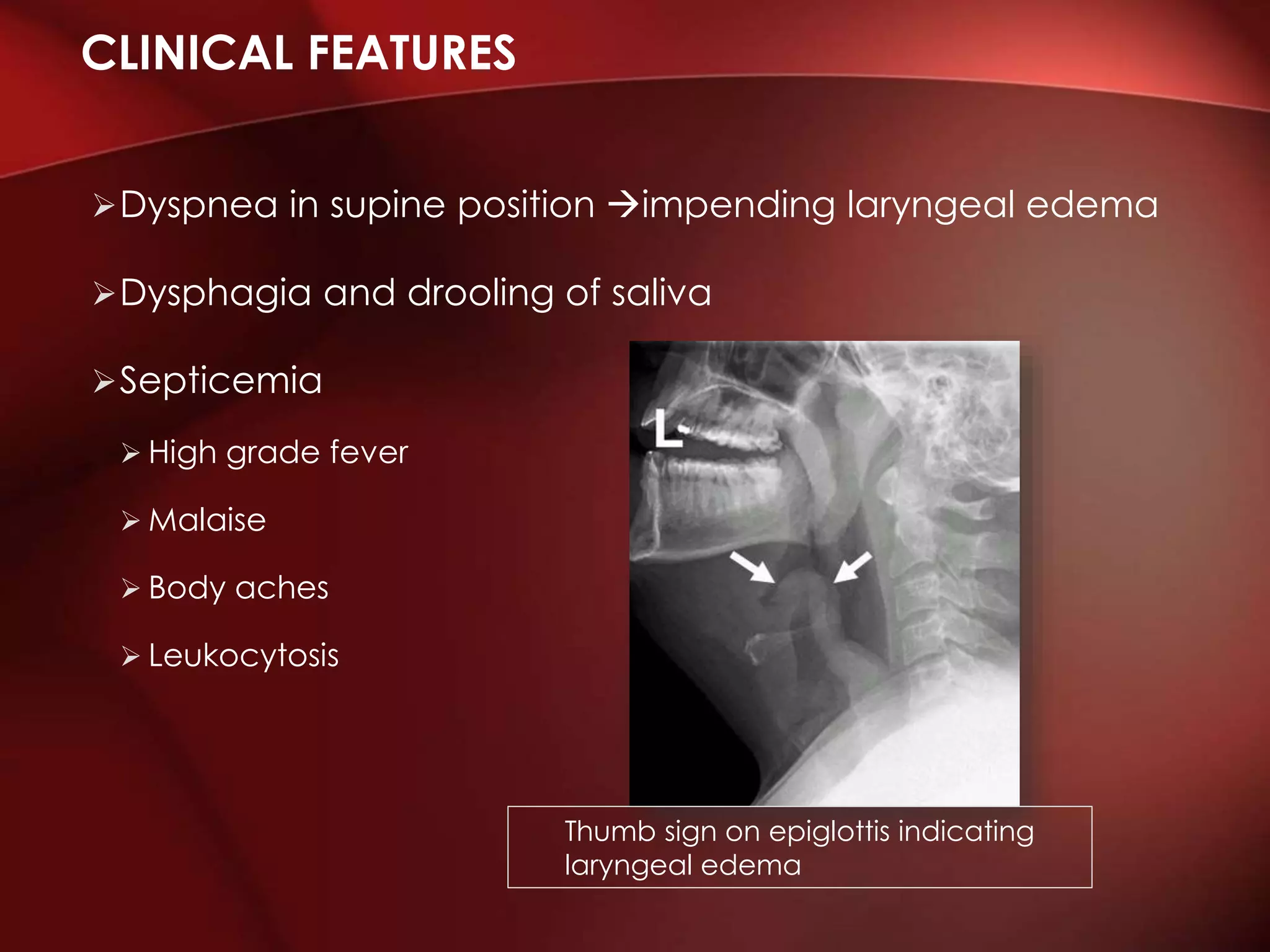 Ludwig’s angina | PPTX