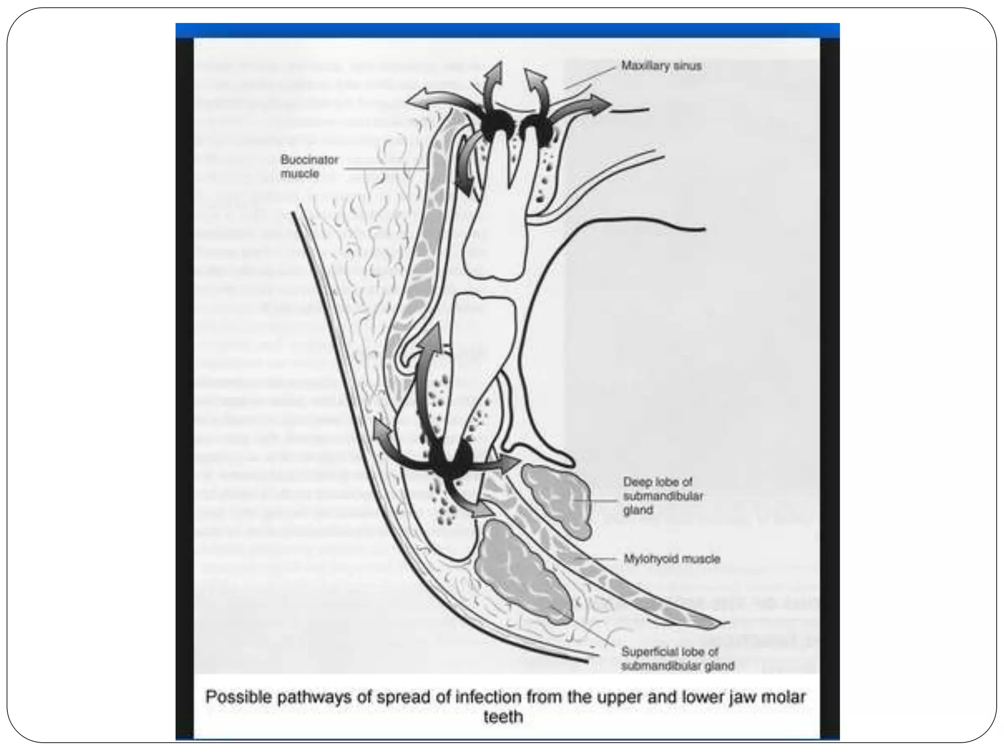 Ludwigs angina | PPTX