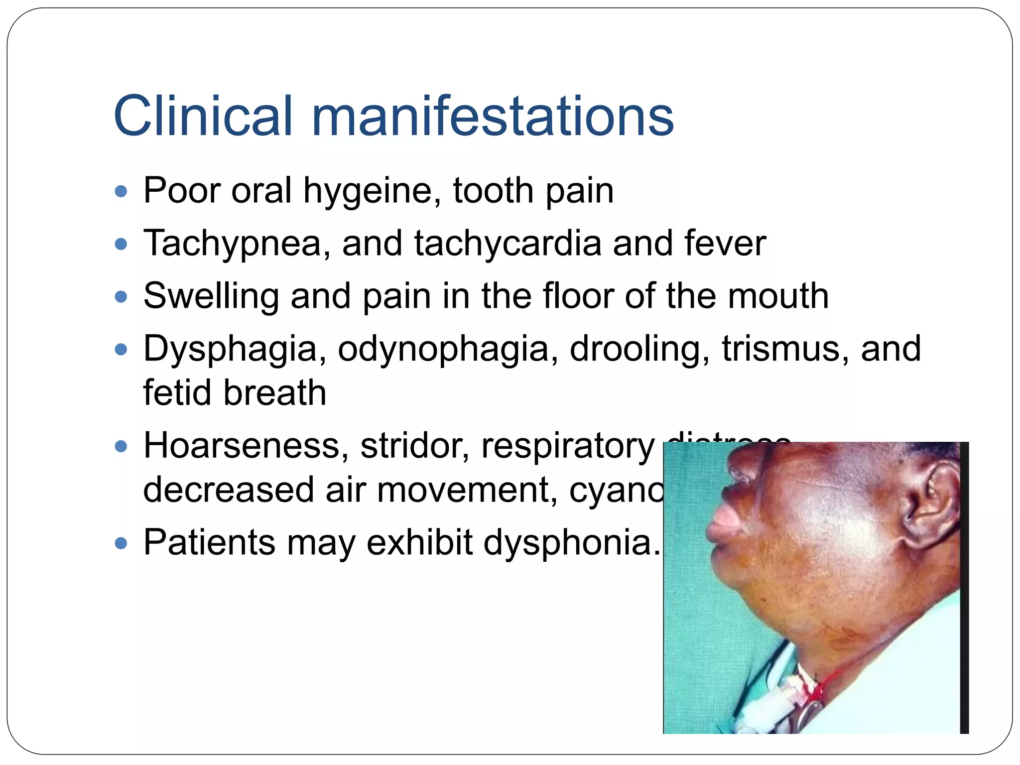 Ludwigs angina | PPTX