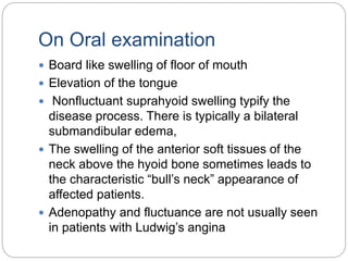 Ludwigs angina | PPTX