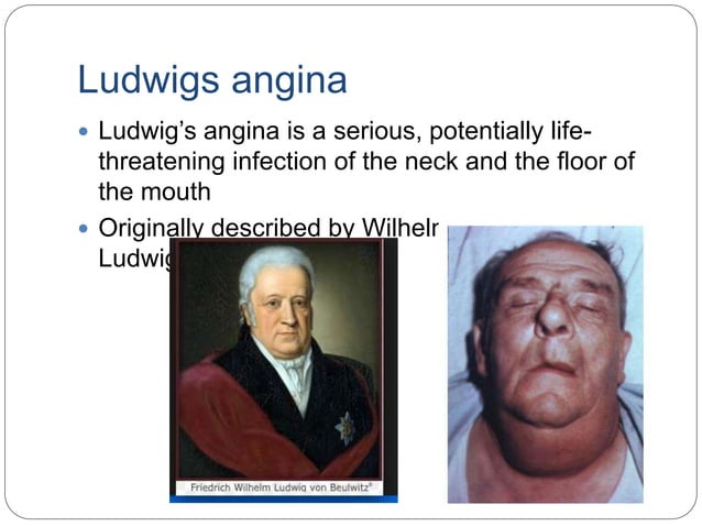 Ludwigs angina | PPTX | Ear, Nose and Throat Conditions | Diseases and ...