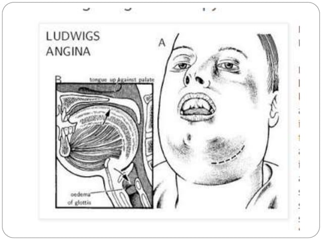 Ludwigs angina | PPTX | Ear, Nose and Throat Conditions | Diseases and ...