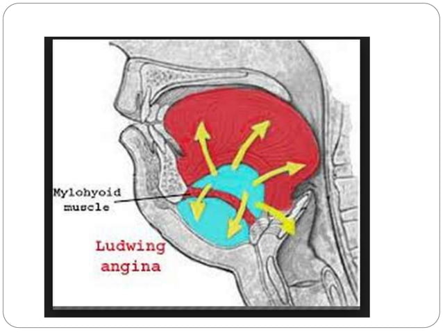 Ludwigs angina | PPTX | Ear, Nose and Throat Conditions | Diseases and ...