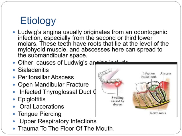Ludwigs angina | PPTX | Ear, Nose and Throat Conditions | Diseases and ...