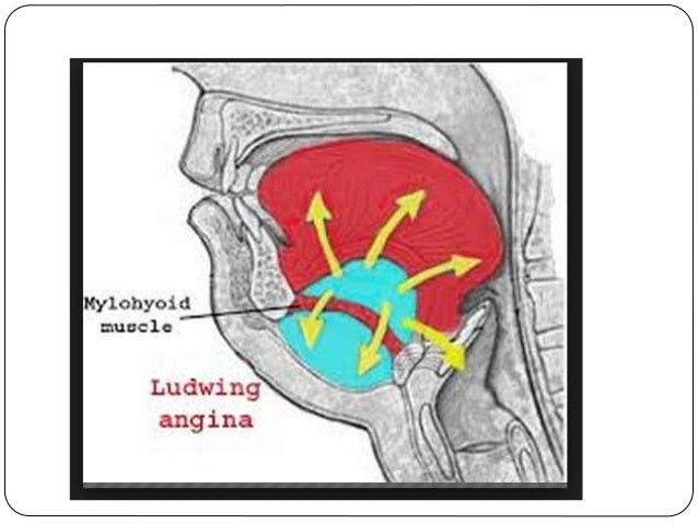 Ludwig's Angina Diagram