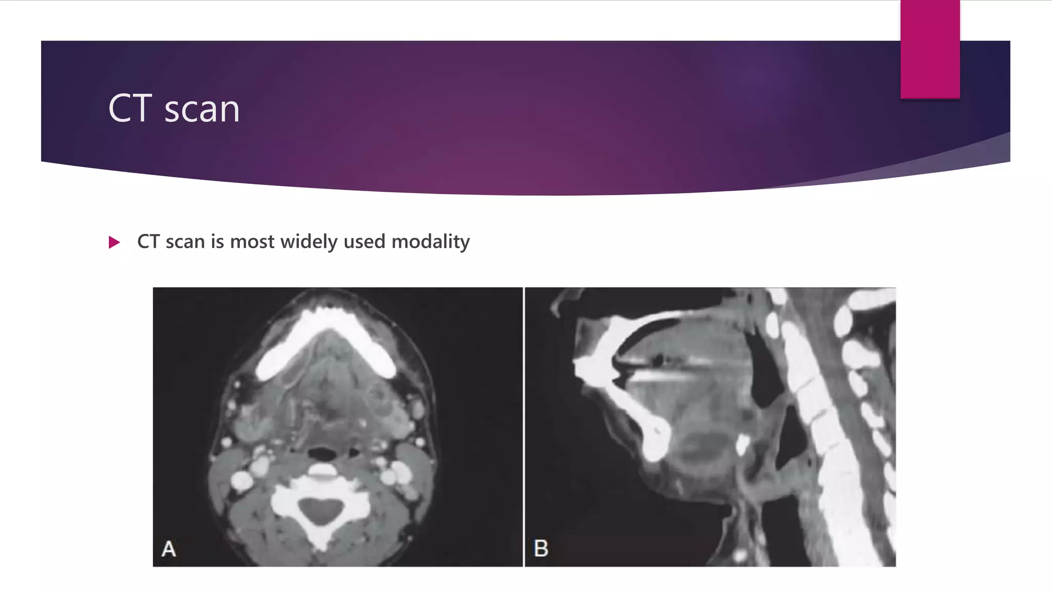 Ludwig's angina | PPTX