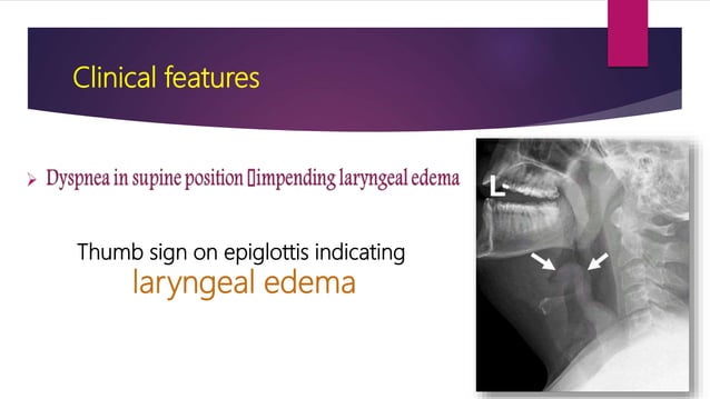 Ludwig's angina | PPTX | Ear, Nose and Throat Conditions | Diseases and ...