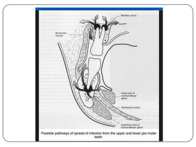 Ludwig’s angina | PPTX | Ear, Nose and Throat Conditions | Diseases and ...