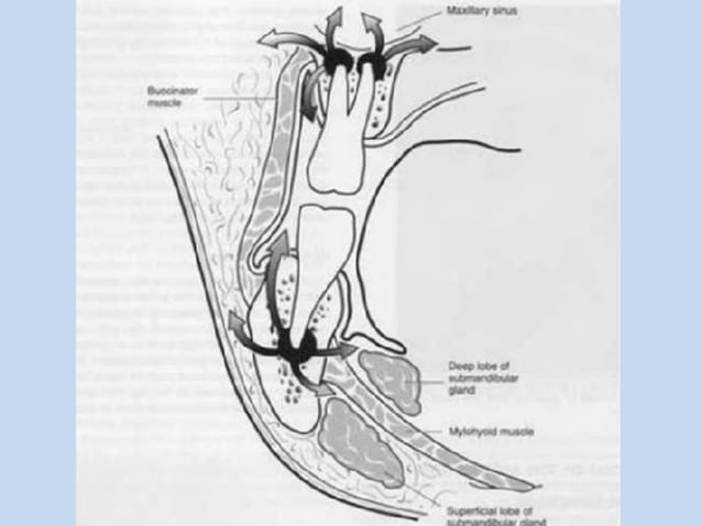 Ludwig's angina | PPTX | Ear, Nose and Throat Conditions | Diseases and ...