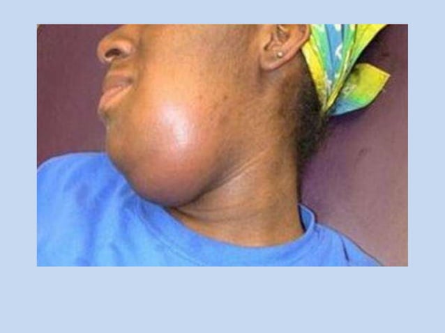 Ludwig's angina | PPTX | Ear, Nose and Throat Conditions | Diseases and ...