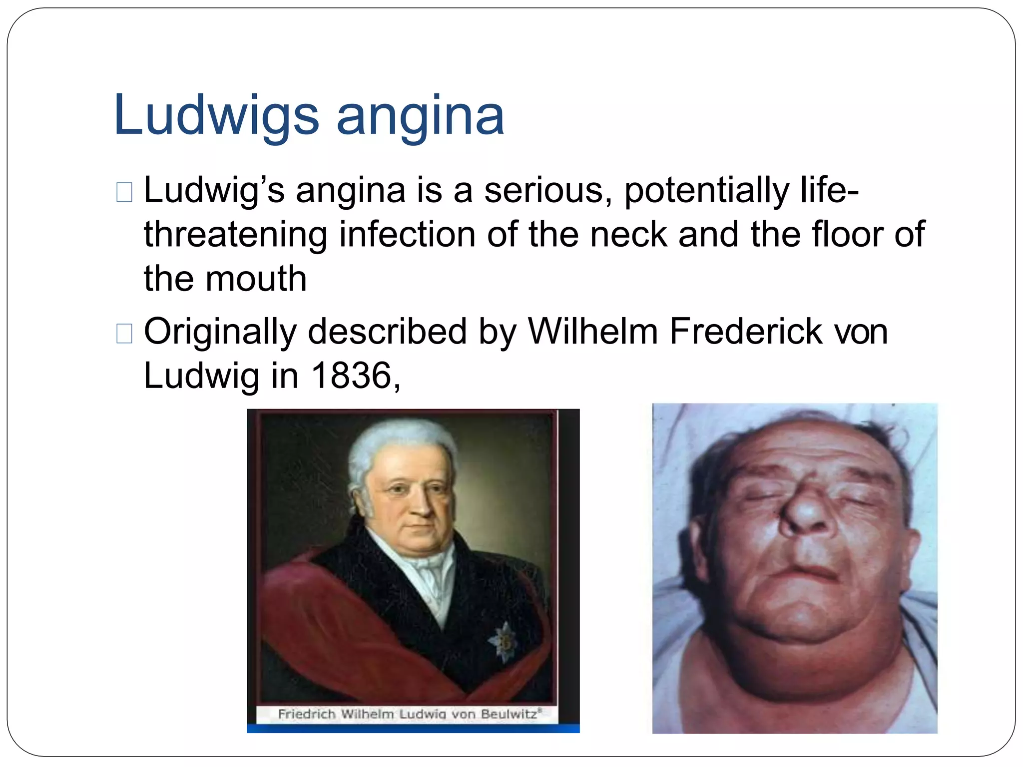 Ludwigs angina | PPTX