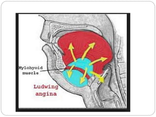 Ludwigs angina | PPT