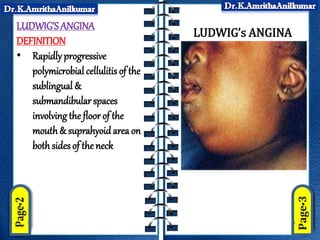 Ludwigs angina by Dr.K.AmrithaAnilkumar | PPTX