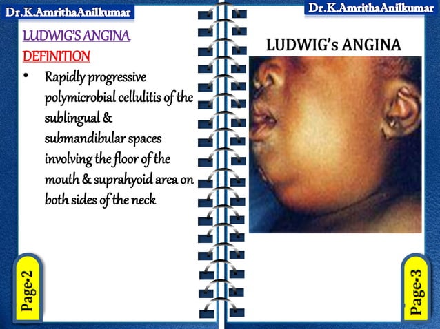 Ludwigs angina by Dr.K.AmrithaAnilkumar | PPT
