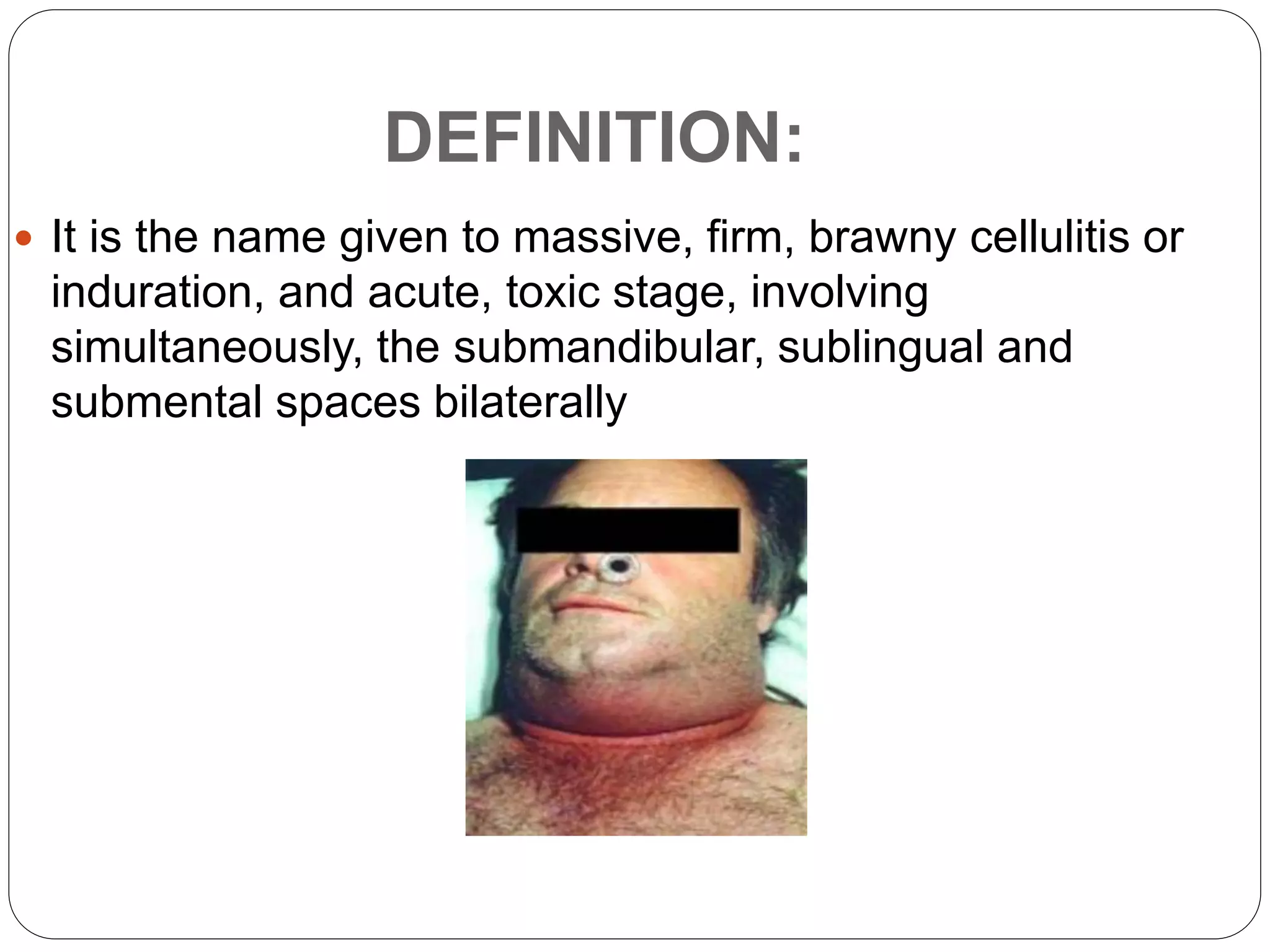 LUDWIG’S ANGINA - DAVISpptx | PPTX