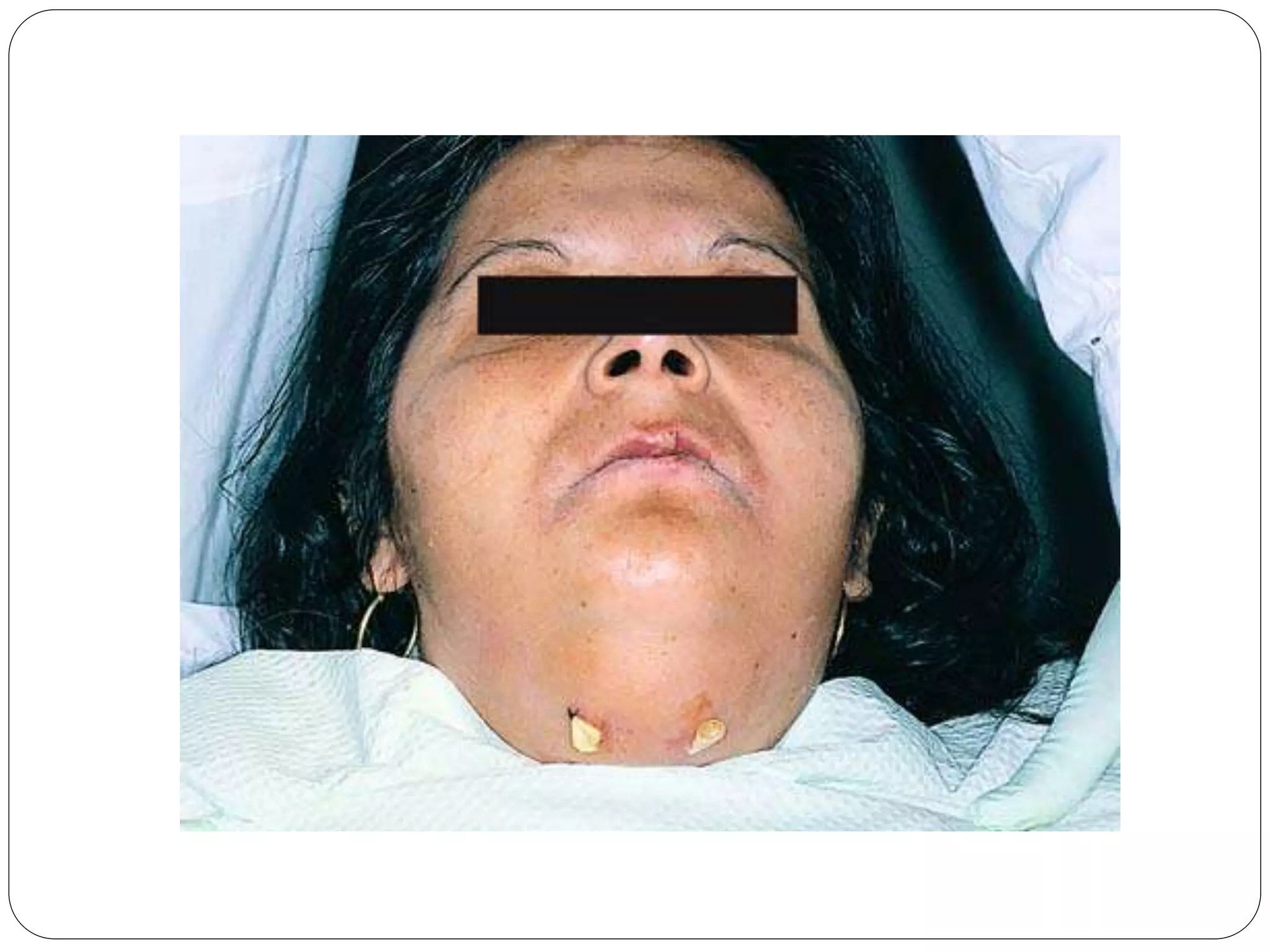 LUDWIG’S ANGINA - DAVISpptx | PPTX