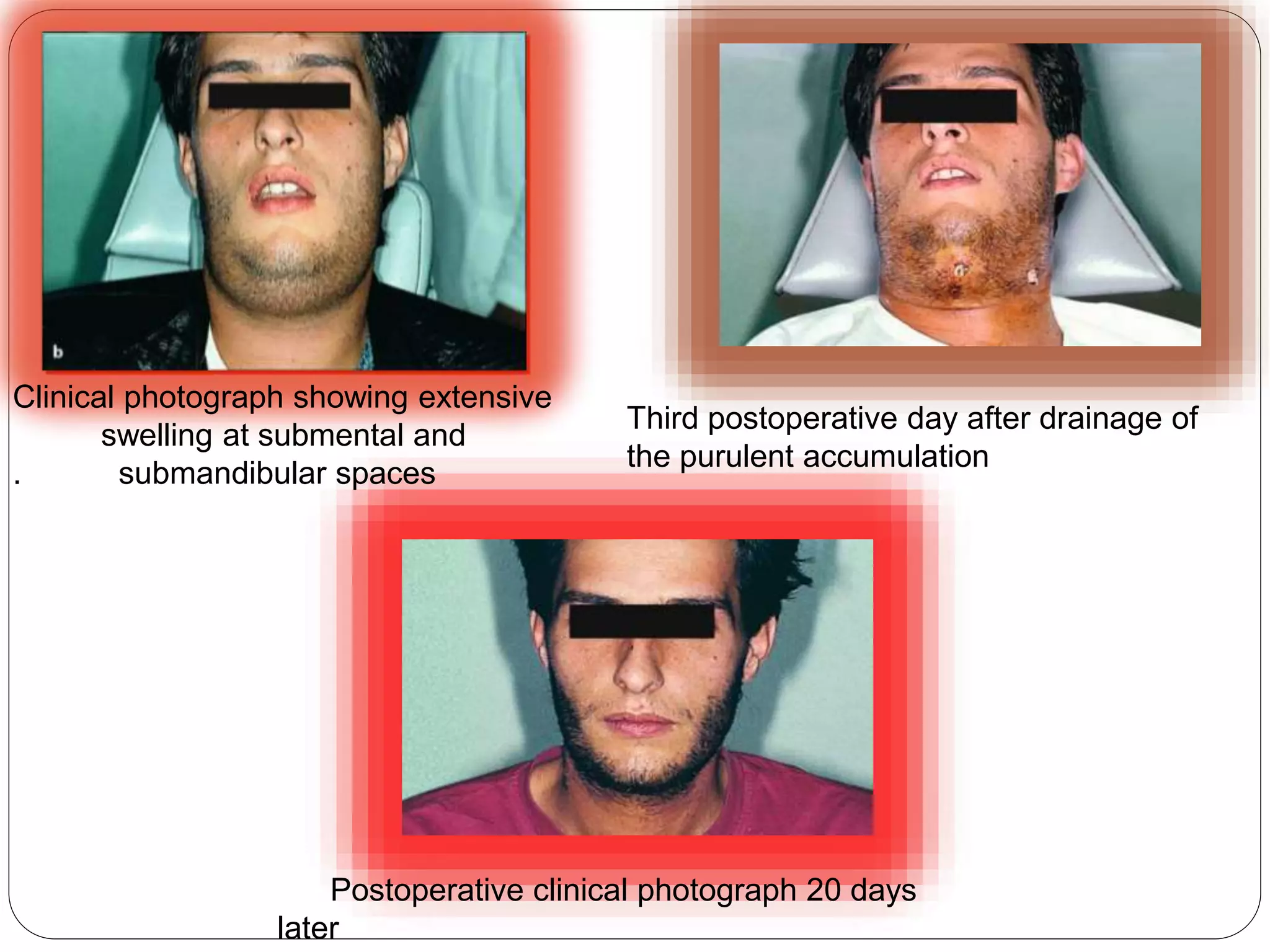 LUDWIG’S ANGINA - DAVISpptx | PPTX