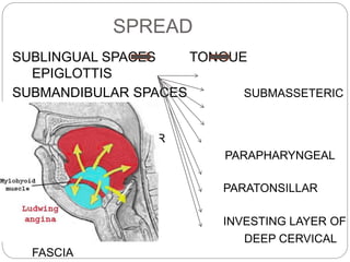 LUDWIG’S ANGINA - DAVISpptx | PPTX