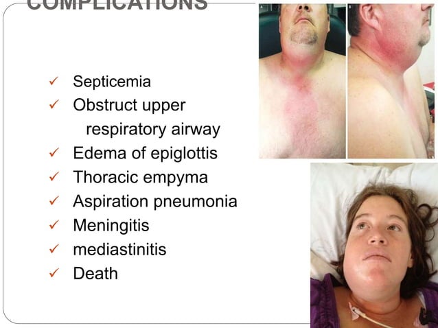LUDWIG’S ANGINA - DAVISpptx | PPTX