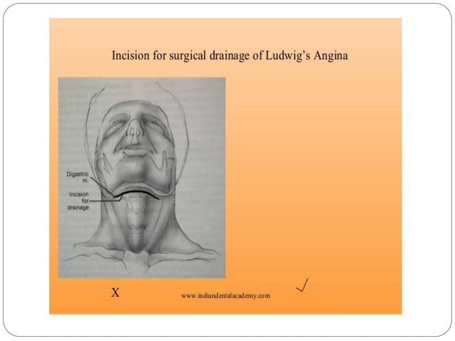 LUDWIG’S ANGINA - DAVISpptx | PPTX