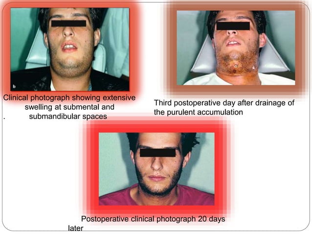 LUDWIG’S ANGINA - DAVISpptx | PPTX