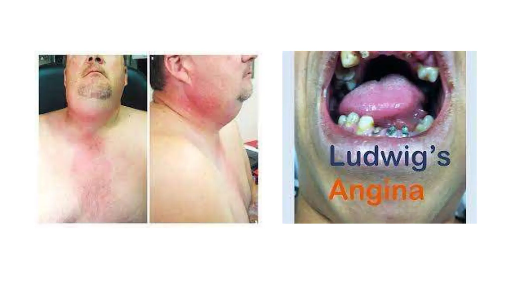 LUDWIG’S ANGINA PRESENTATION CELLULITIS.pptx