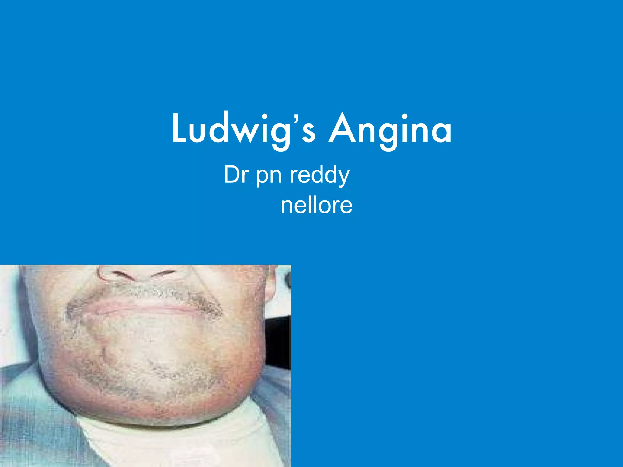 Ludwigs angina & anaesthetic management | PPT