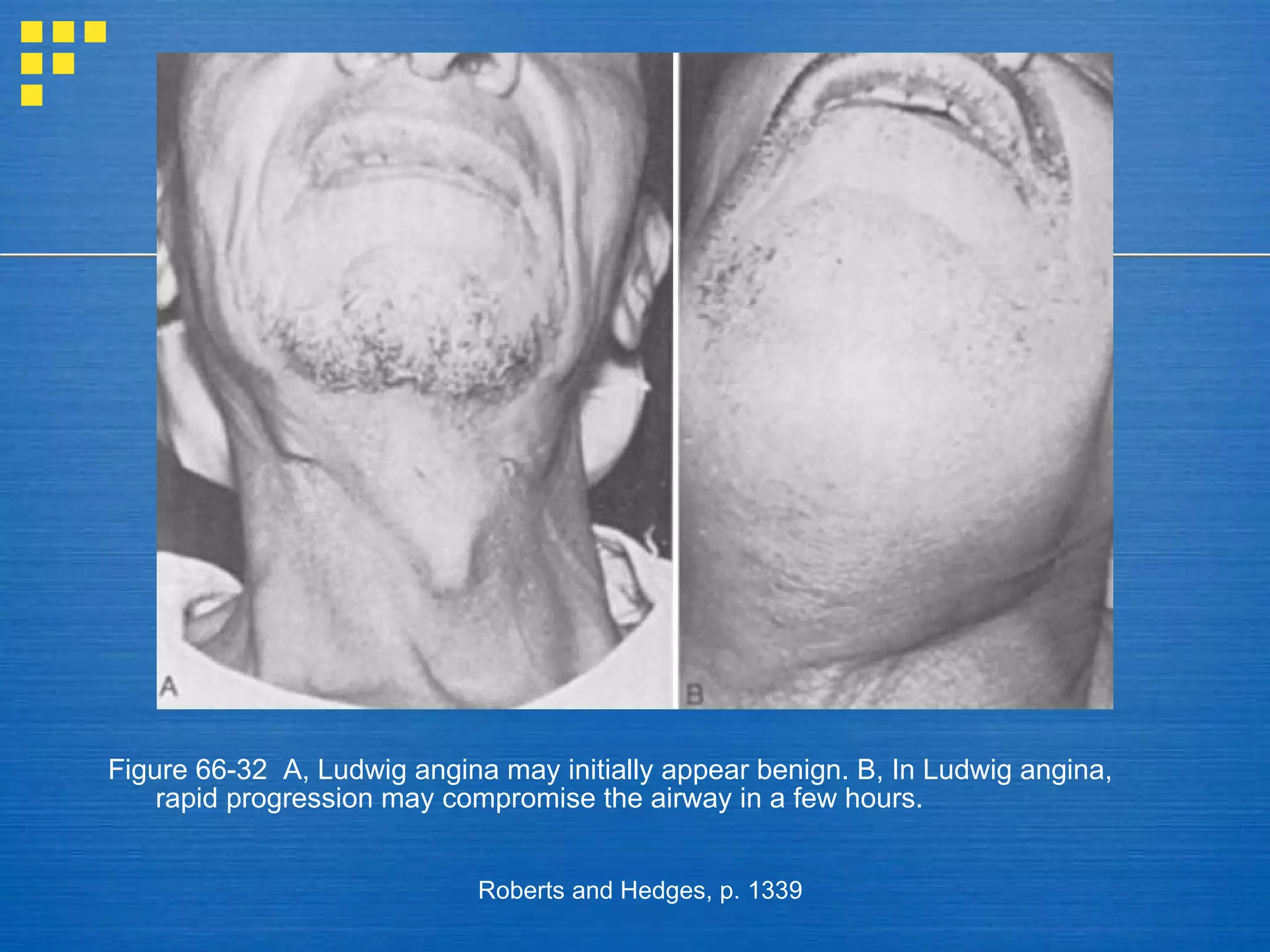 Ludwigs angina & anaesthetic management | PPT