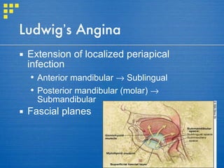 Ludwigs angina & anaesthetic management | PPT