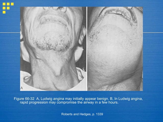 Ludwigs angina & anaesthetic management | PPT | Dental Health ...
