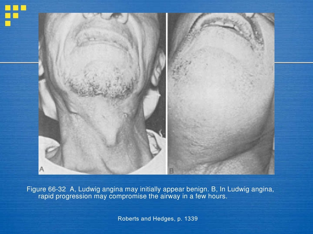 Ludwigs angina & anaesthetic management