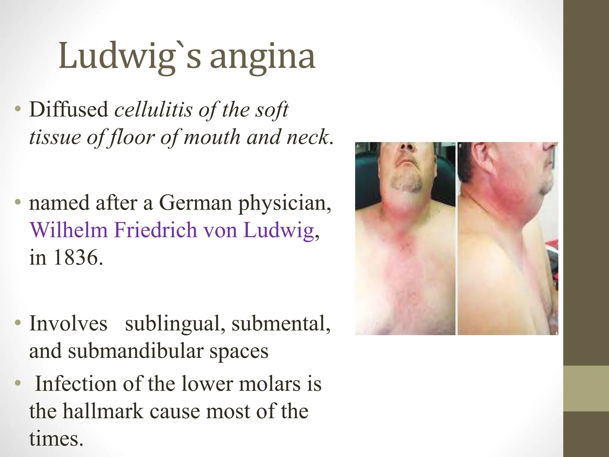 Ludwig`s Angina history and examination and management.pptx