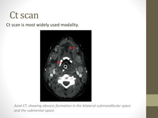 Ludwig`s Angina history and examination and management.pptx