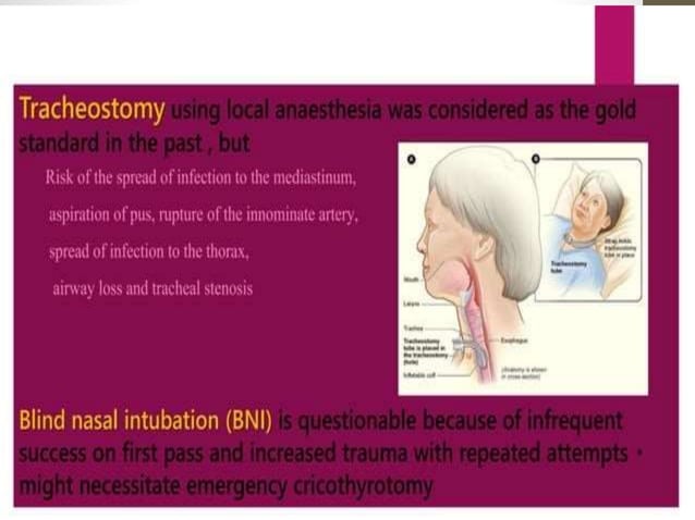 Ludwig`s Angina history and examination and management.pptx | Ear, Nose ...