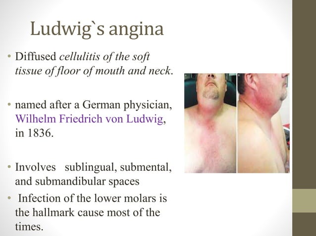 Ludwig`s Angina history and examination and management.pptx | Ear, Nose ...