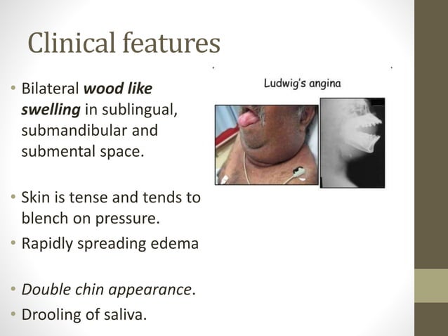 Ludwig`s Angina history and examination and management.pptx | Ear, Nose ...