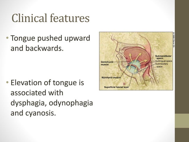 Ludwig`s Angina history and examination and management.pptx | Ear, Nose ...