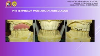 Enmuflado, acrilizado y pulido de la PPR.pptx